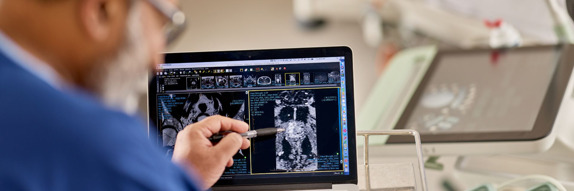 Renal Cysts – Urology SA